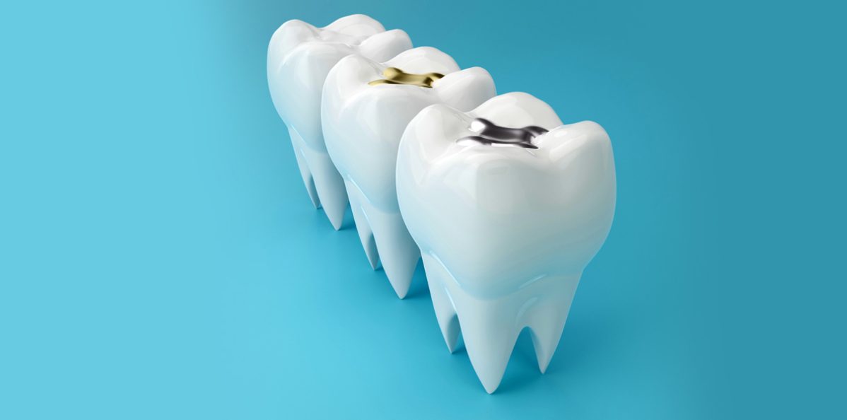 How Modern Technology Has Improved Dental Fillings